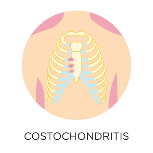 Costochondritis Symptoms Treatments Recovery And More costochondritis-symptoms-treatments-recovery-and-more