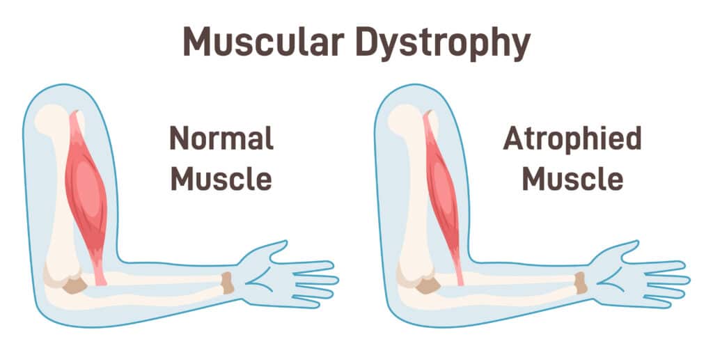 Muscular Dystrophy – Symptoms, Treatments, Recovery…
