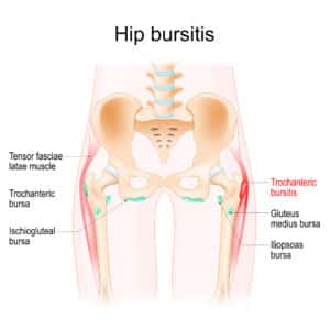 Hip Bursitis – Symptoms, Treatments, Recovery and more…