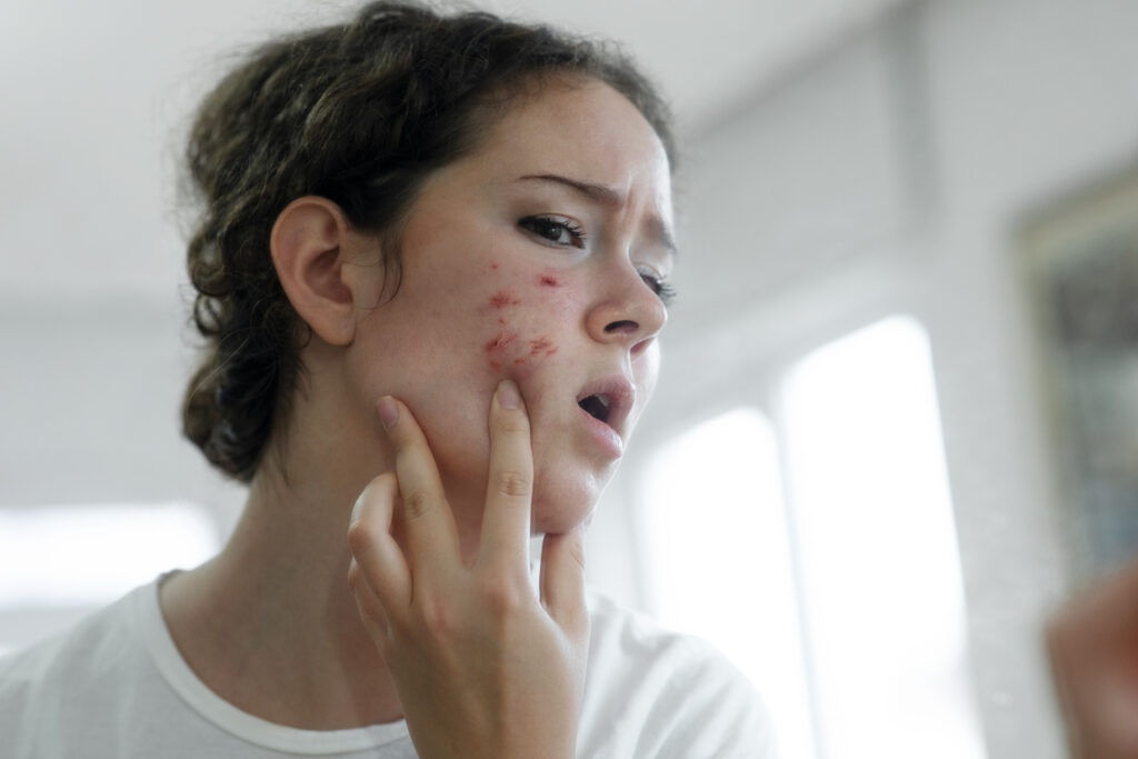 Acne - CARESPACE Health+Wellness