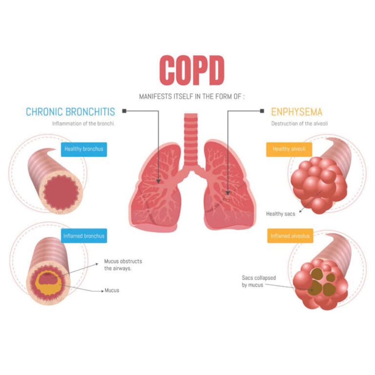 COPD - CARESPACE Health+Wellness