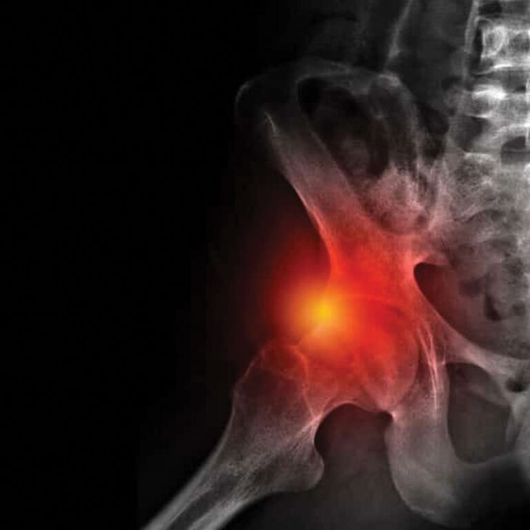 Femoroacetabular Impingement - CARESPACE Health+Wellness