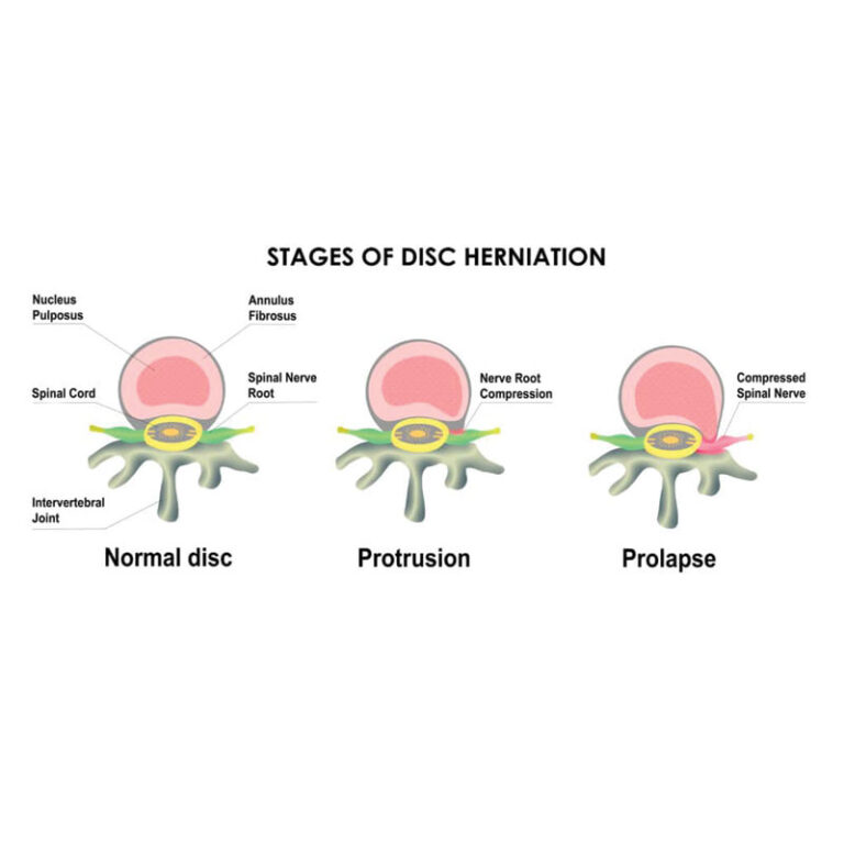Cervical Disc Herniation - CARESPACE Health+Wellness