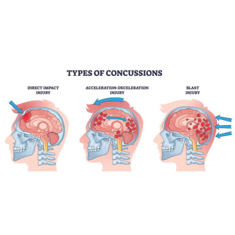 Concussions - CARESPACE Health+Wellness