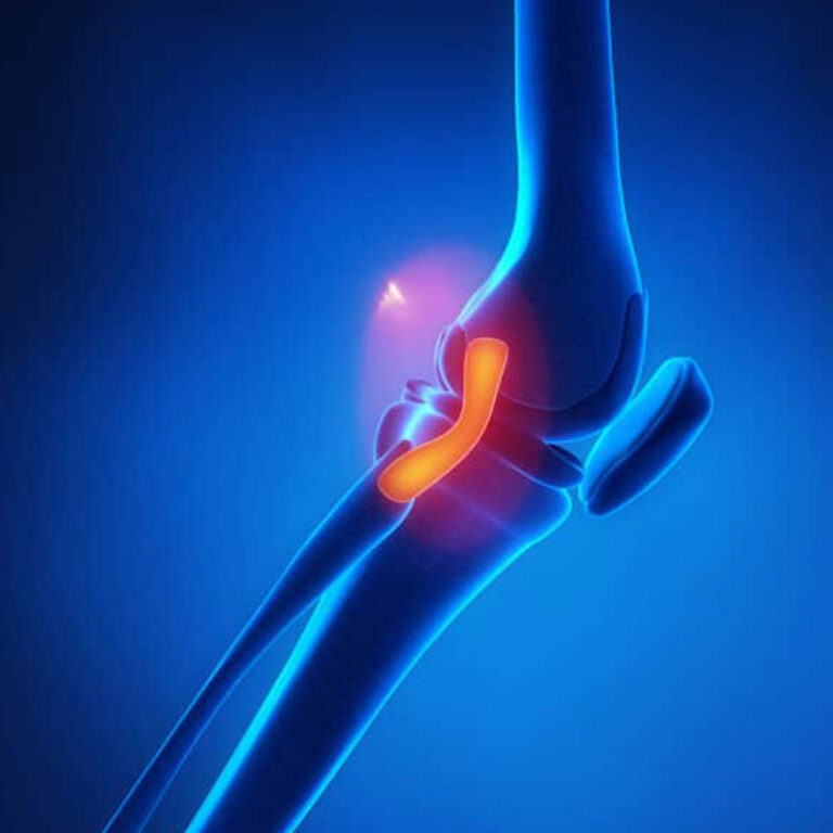 LCL Sprain - CARESPACE Health+Wellness