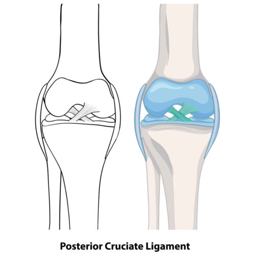 PCL Tear - CARESPACE Health+Wellness