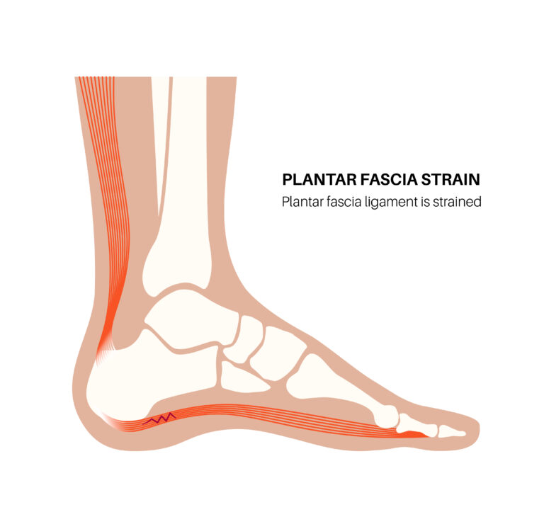 Plantar Fascia Strain - CARESPACE Health+Wellness