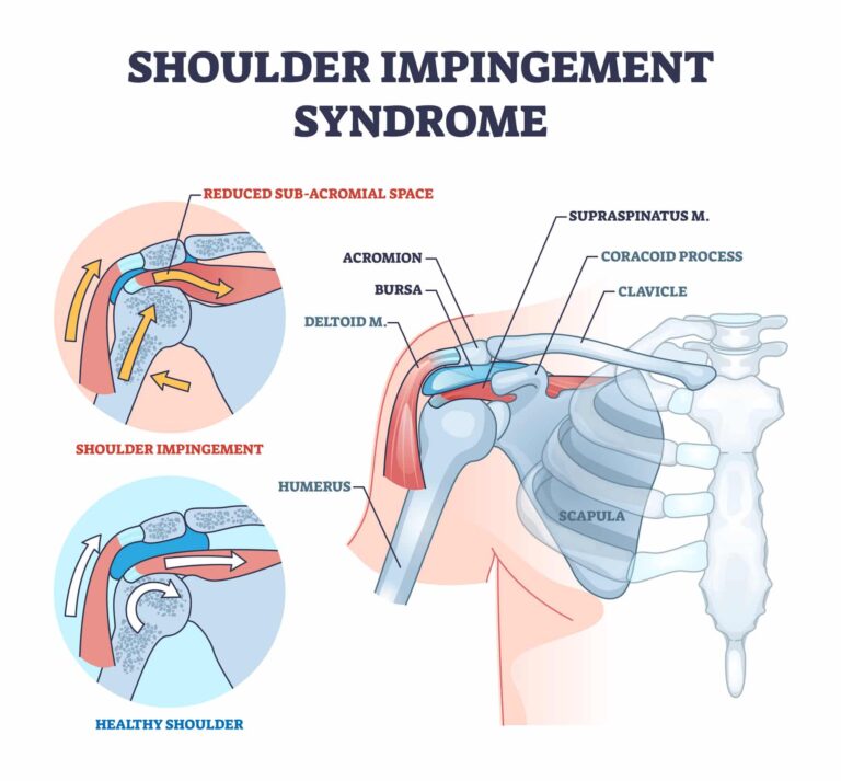 Shoulder Impingement Syndrome - CARESPACE Health+Wellness