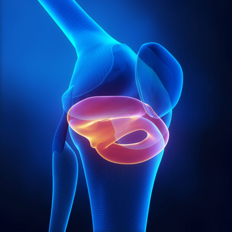 Meniscal Injury - CARESPACE Health+Wellness