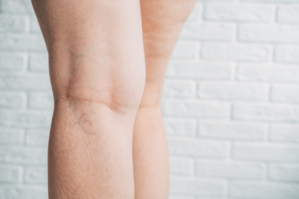 Stasis Dermatitis - CARESPACE Health+Wellness